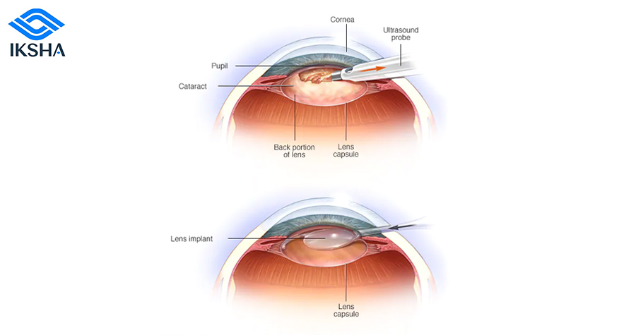 The Future of Cataract Surgery: What's on the Horizon? - IKSHA EYE CARE